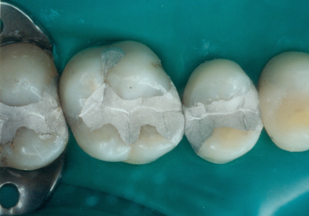 Amalgam Before & After Pictures in Concord, NH | Freese & Bengtson ...